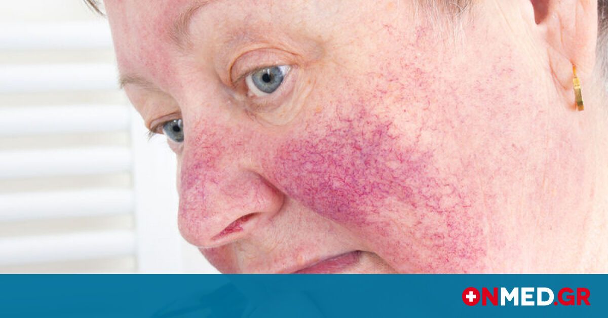 Ροδόχρους ακμή: Αιτίες και συμπτώματα της ακμής των ενηλίκων (εικόνες)