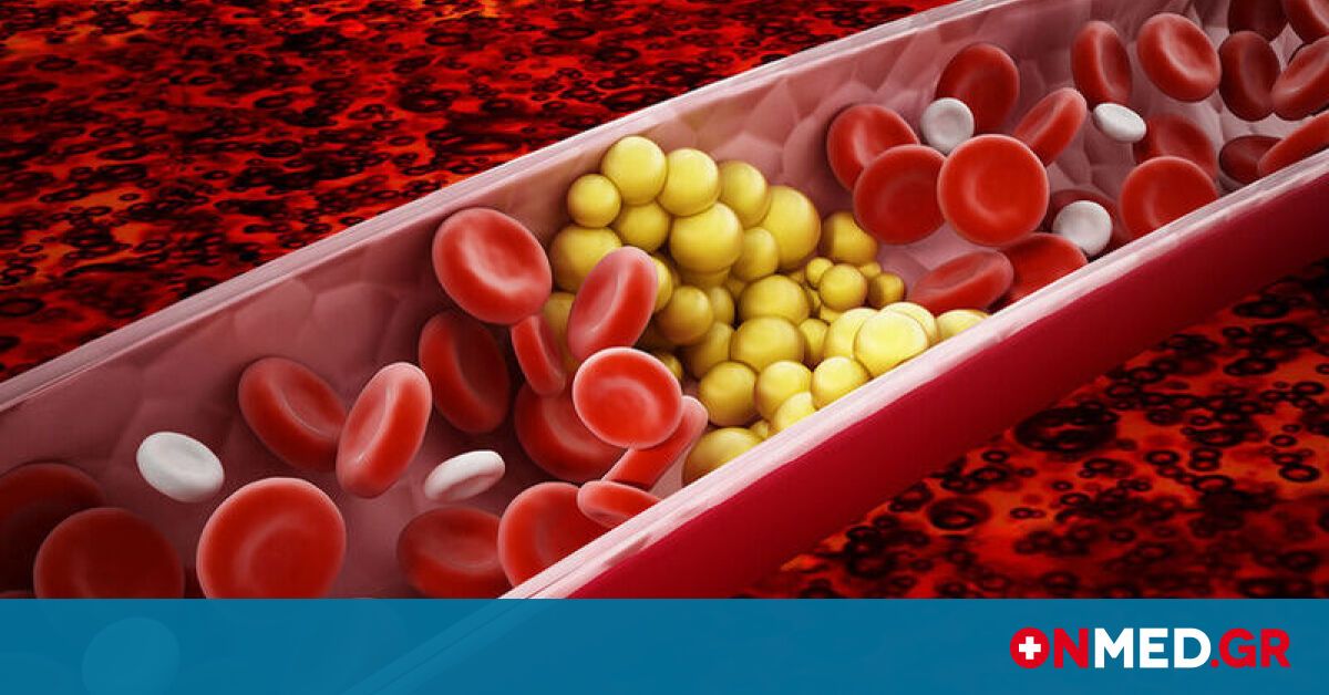 Υψηλή χοληστερόλη: 9 συμπτώματα που δεν πρέπει να αγνοήσετε (video)