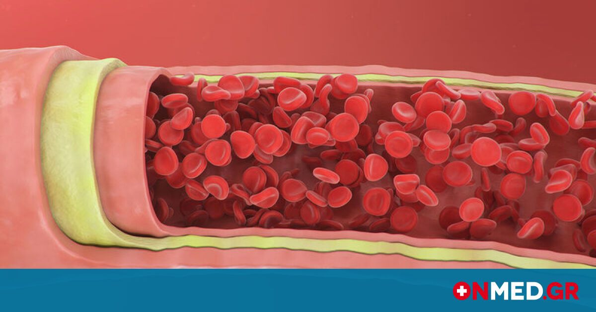 Άσκηση: Το είδος που μειώνει την αρτηριακή πίεση και την ακαμψία των ...