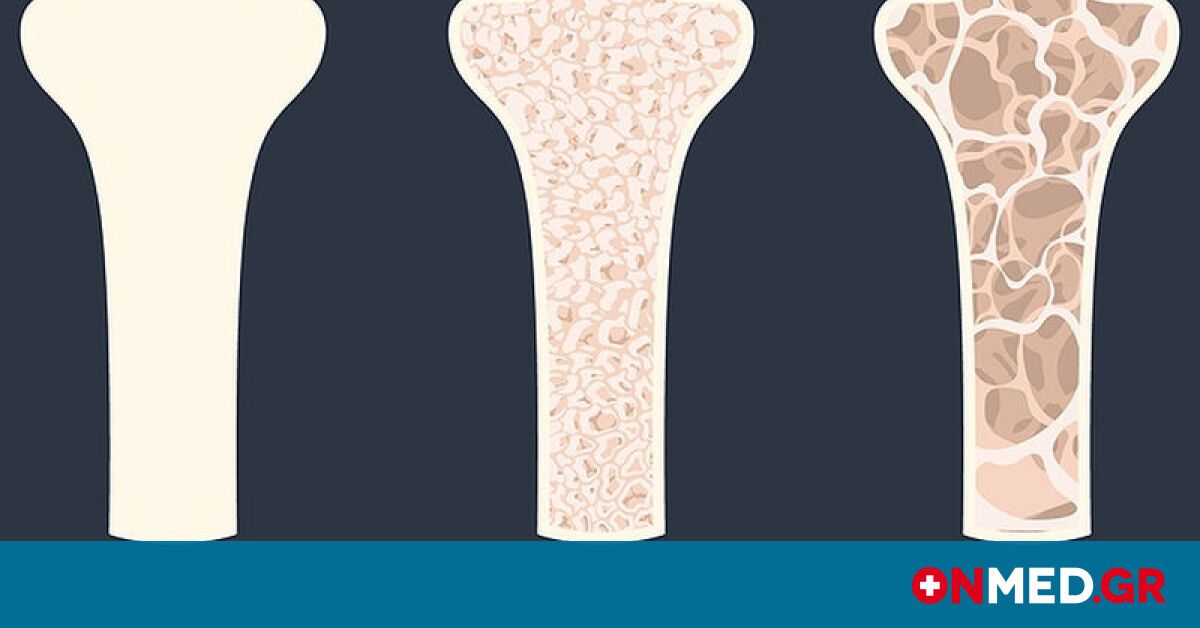 Οστεοπόρωση: Ο συνδυασμός που προλαμβάνει την απώλεια της οστικής μάζας