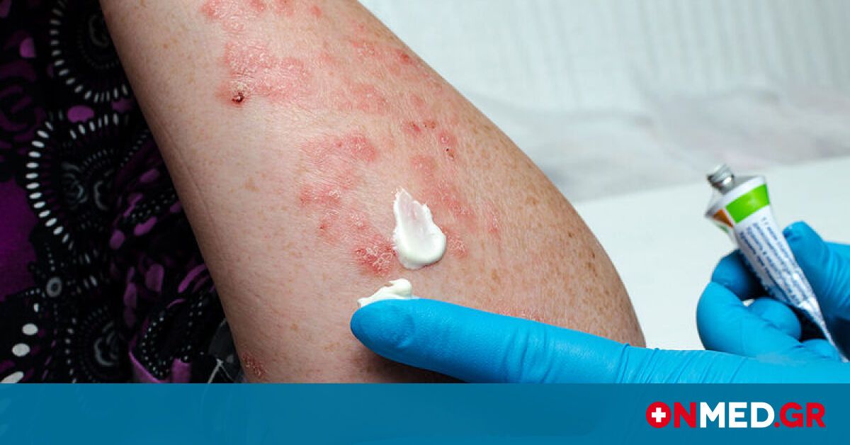 Ψωριασική αρθρίτιδα: Ποια διατροφή πρέπει να ακολουθείτε (video)