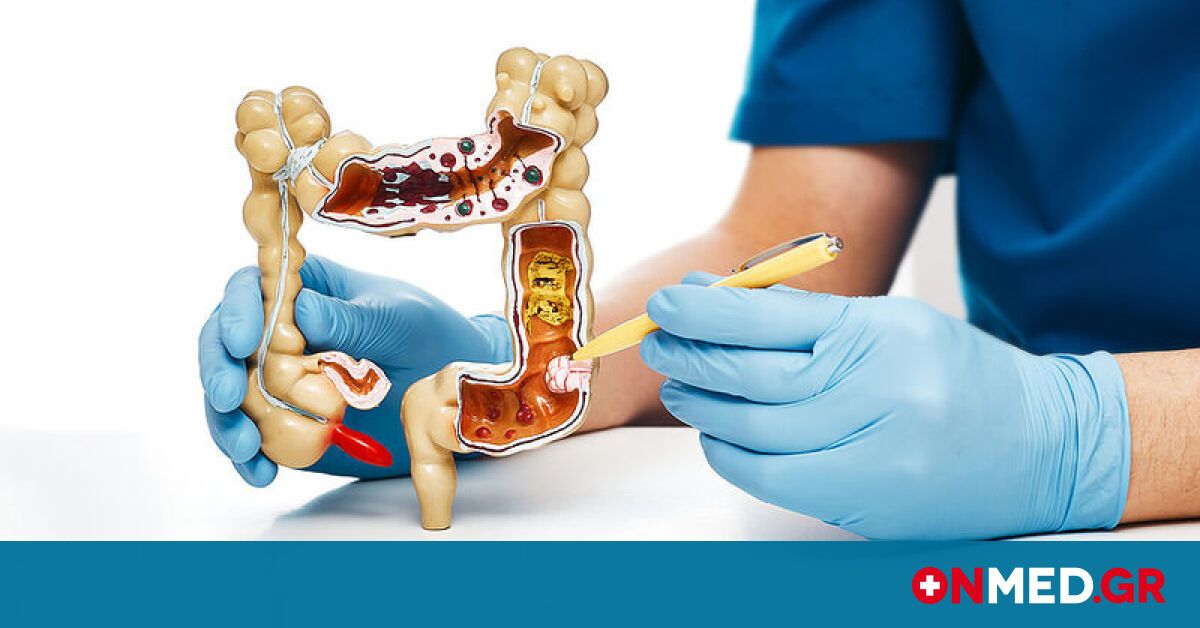 Καρκίνος παχέος εντέρου: Τι μπορείτε να κάνετε για να τον προλάβετε ...