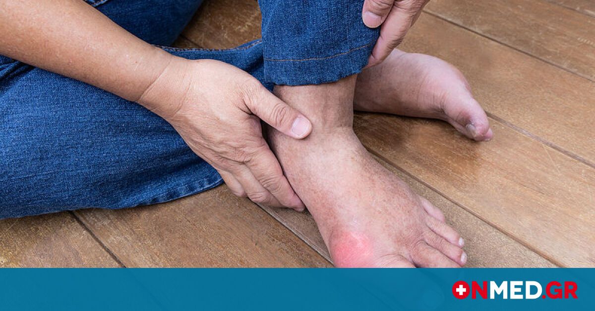 Ουρικό οξύ: 10 φυσικοί τρόποι να το μειώσετε (video)