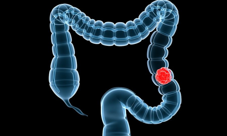 Καρκίνος παχέος εντέρου: 10 συμπτώματα που δεν πρέπει να αγνοήσετε (video)