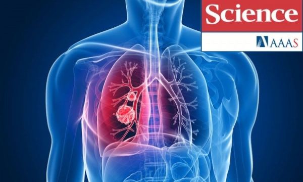 ΚΑΡΚΙΝΟΣ ΤΟΥ ΠΝΕΥΜΟΝΑ ΔΙΑΓΝΩΣΗ