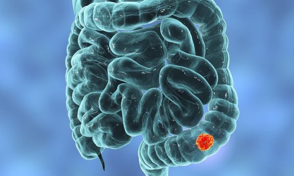 ΚΑΡΚΙΝΟΣ ΕΝΤΕΡΟΥ ΠΡΟΛΗΨΗ