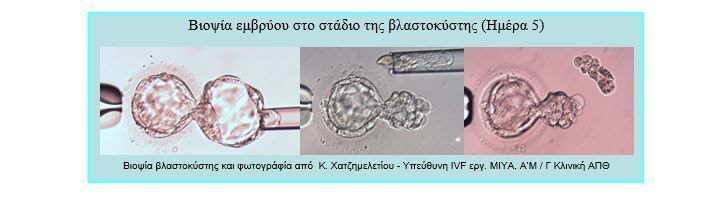 Προεμφυτευτική γενετική διάγνωση - Αναπαραγωγική λύση με αυξημένα ...